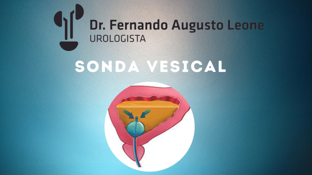 Sonda Vesical - Dr. Fernando Leone - Urologista BH - Urologista BH