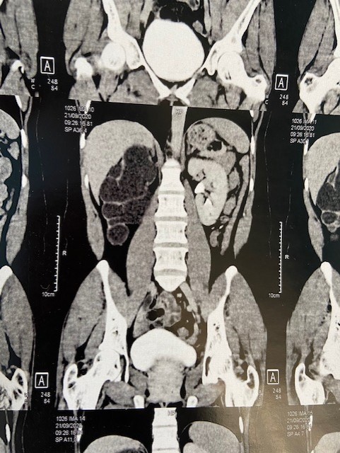 O Que É Hidronefrose? Dr. Fernando Leone - Urologista BH - Urologista BH