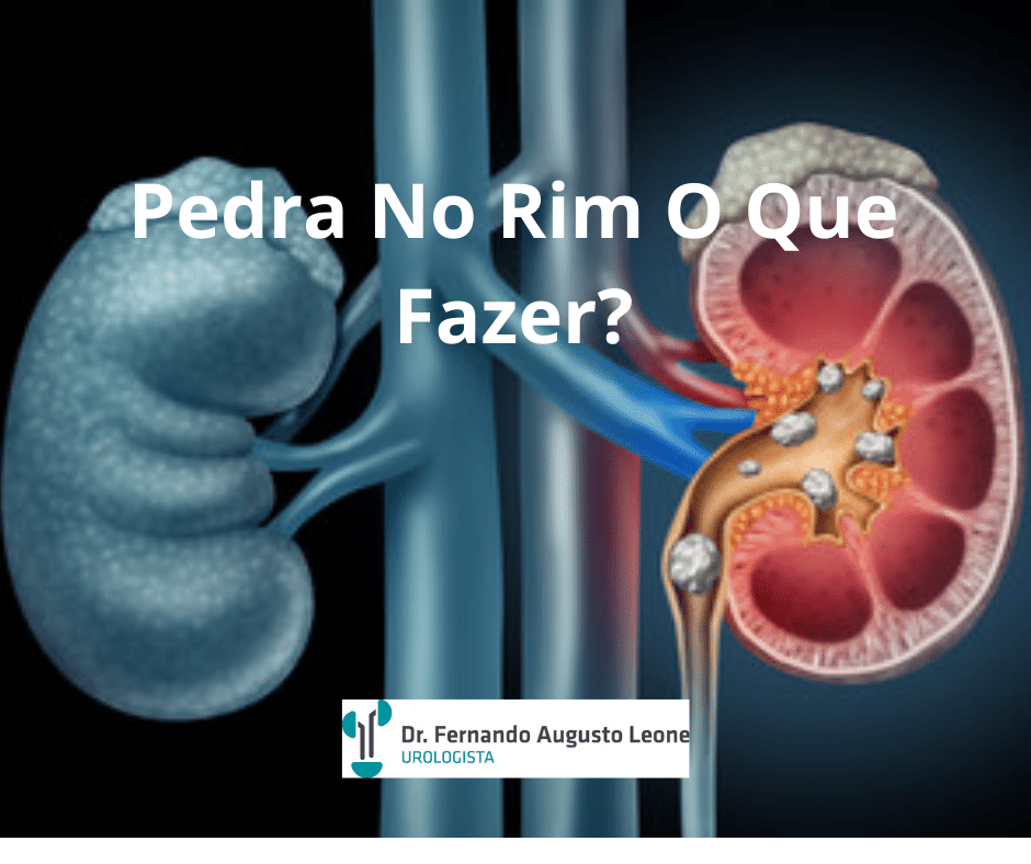 Pedra No Rim O Que Fazer? - Dr. Fernando Leone - Urologista BH